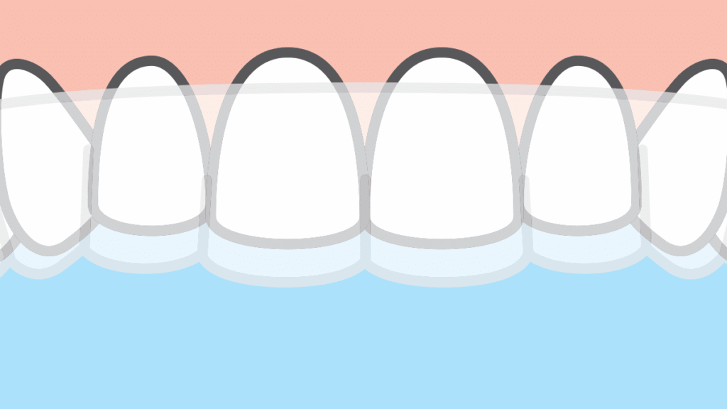 How to Properly Insert Invisalign Aligners - Bracesetters